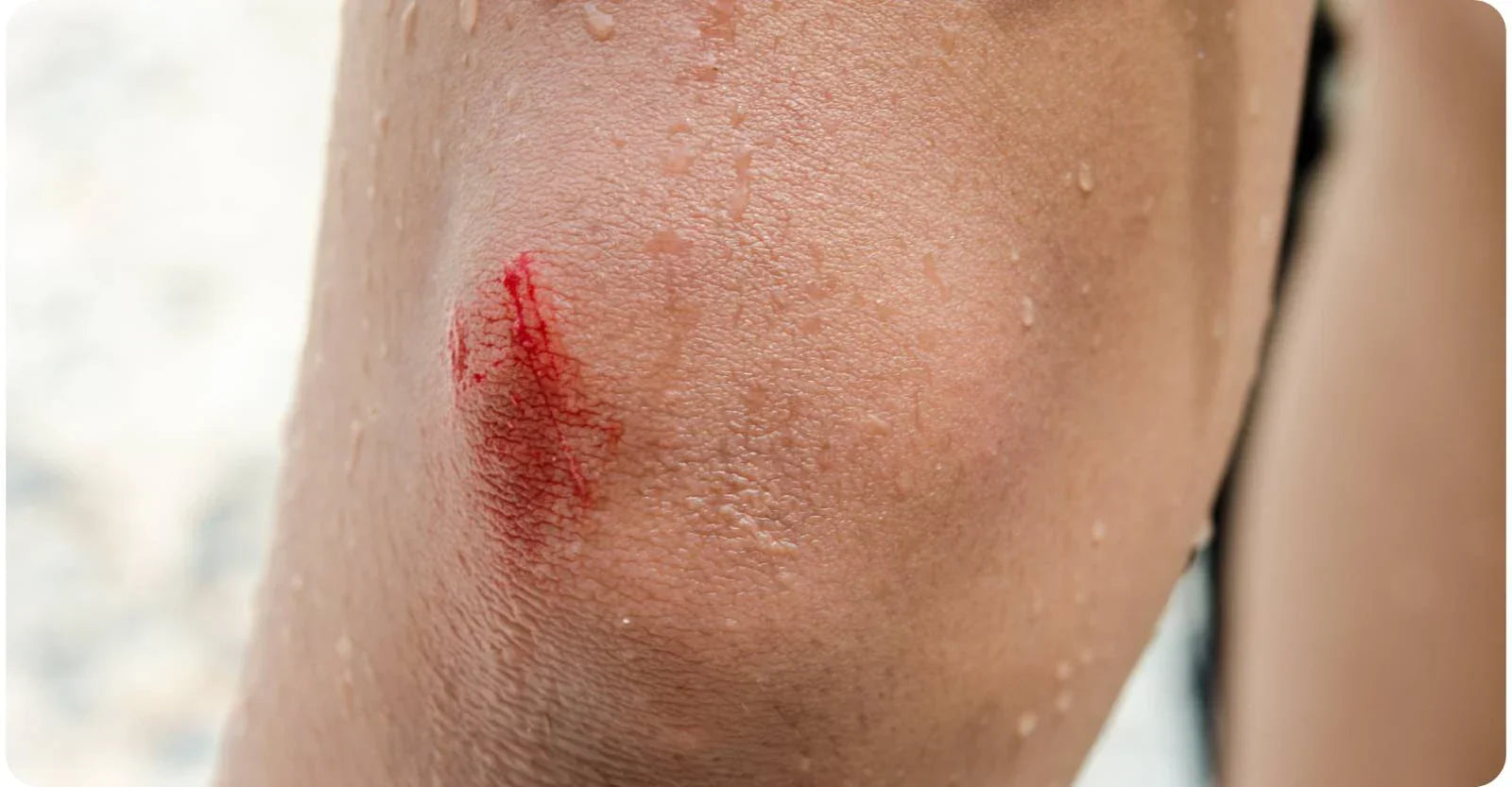 Red Light Therapy For Wound Healing